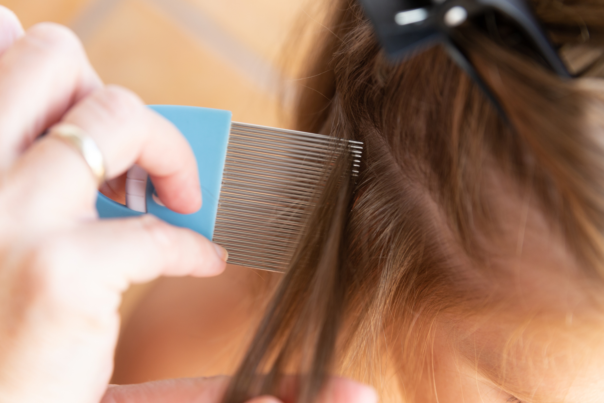 Poux : quels sont les signes permettant de repérer une infestation chez ...