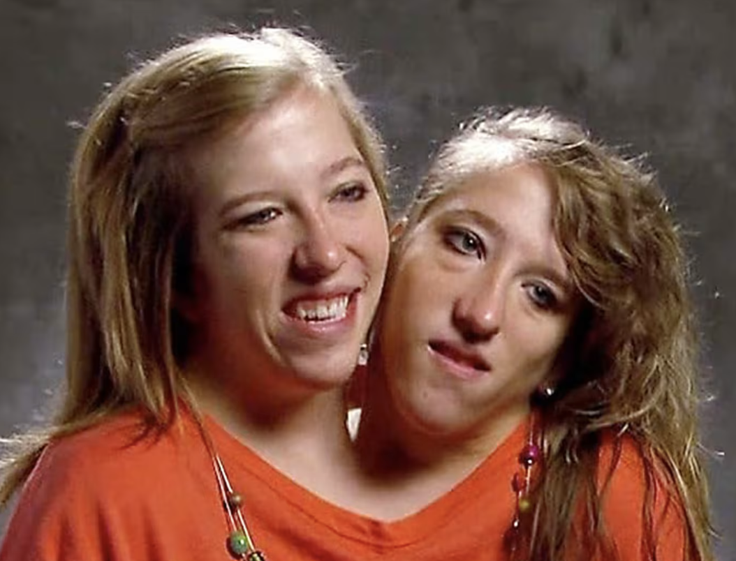 Abby et Britanny, les célèbres sœurs siamoises, se sont mariées (Vidéo) | Parents.fr