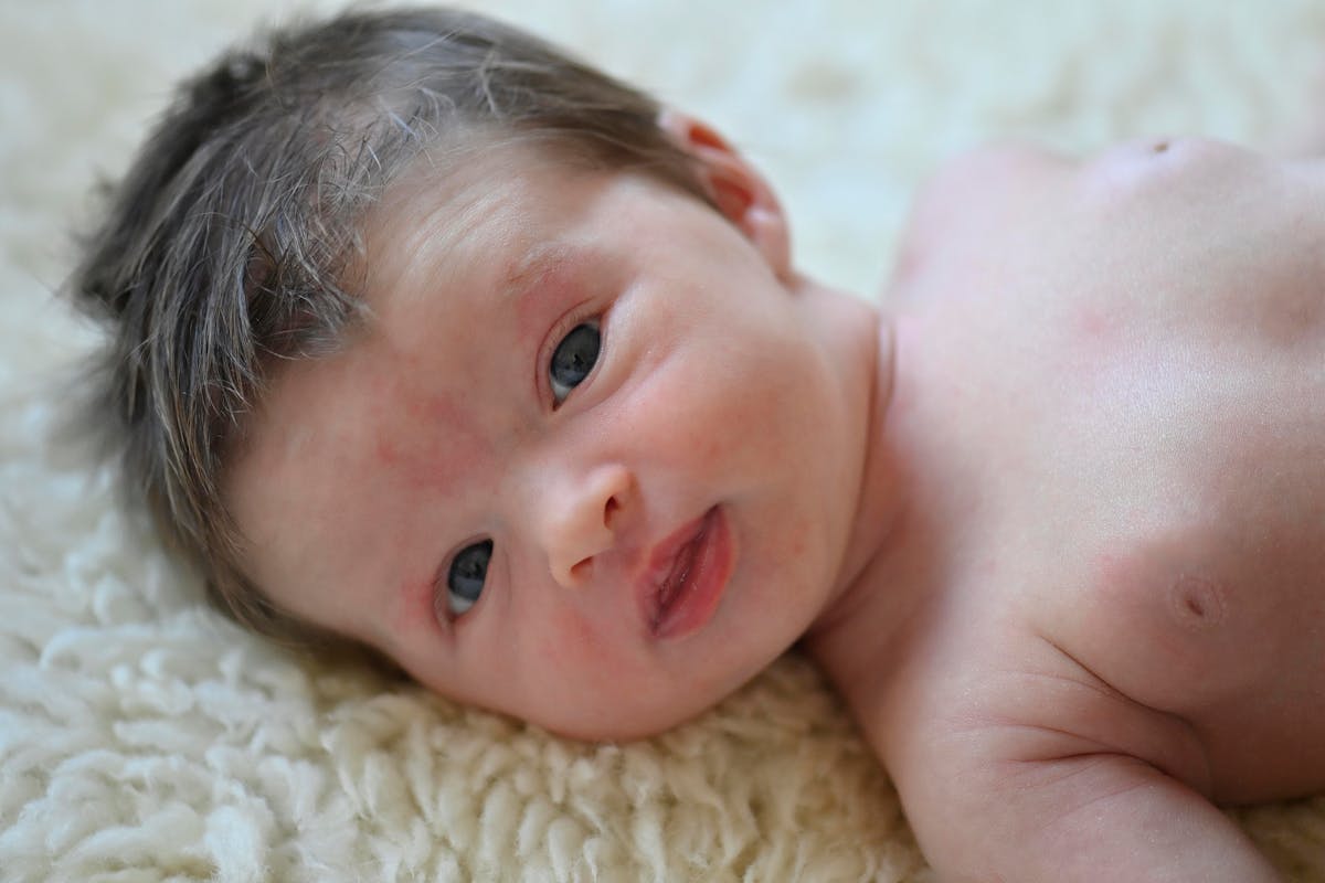 Morsure de cigogne ou baiser de l’ange : comment reconnaître cette ...