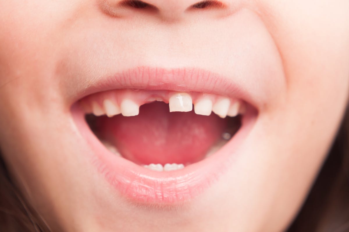 Voici l’âge à partir duquel un enfant perd ses dents | Parents.fr